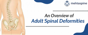 An Overview of Adult Spinal Deformities - Mehta Spine - Children and ...