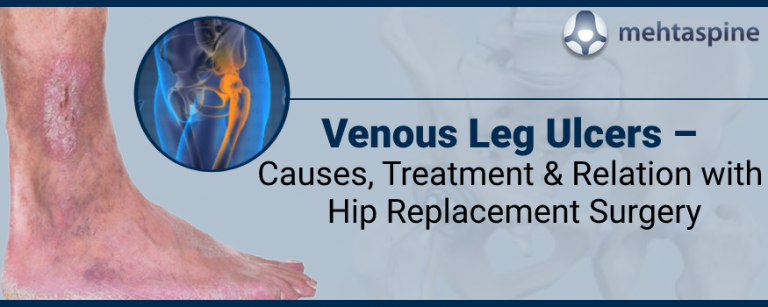 Risk Factors Associated With Venous Leg after hip replacement