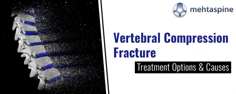 Vertebral Compression Fracture Treatment Options & Causes